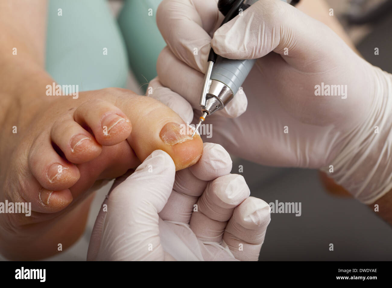 Medical Foot Care with a Grinding Machine Stock Photo - Alamy