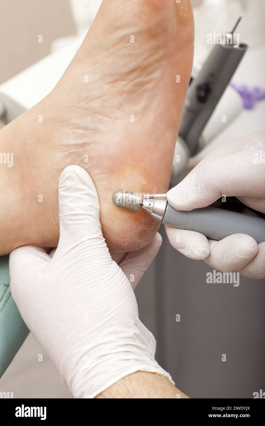 A chiropodist taking care of woman's foot - Grinding with a machine dry ...