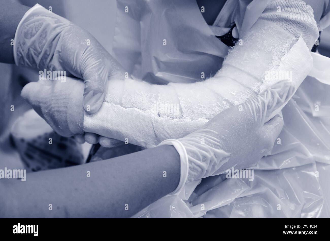 Arm Broken Cast High Resolution Stock Photography and Images - Alamy