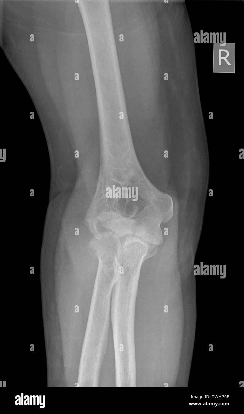 Humerus Bone X Ray