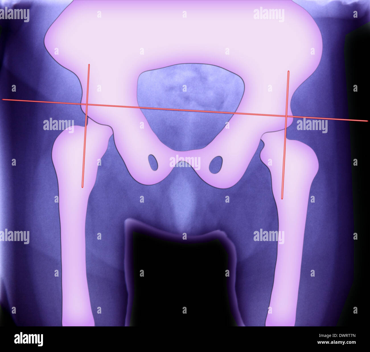 Congenital dislocation of the hi-res stock photography and images - Alamy