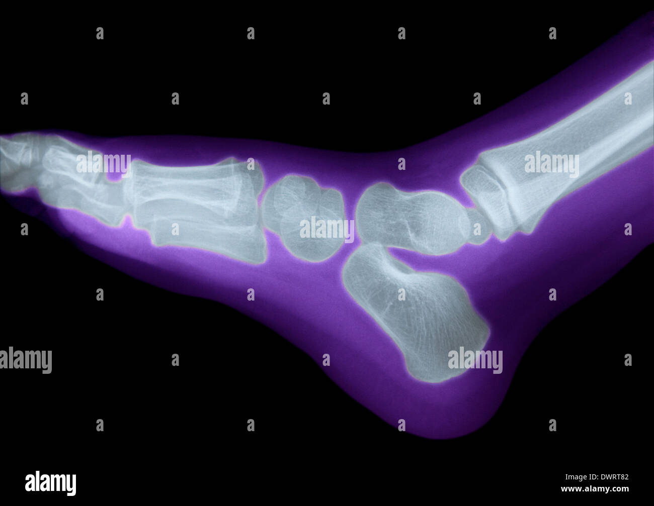 Foot x ray Stock Photo - Alamy