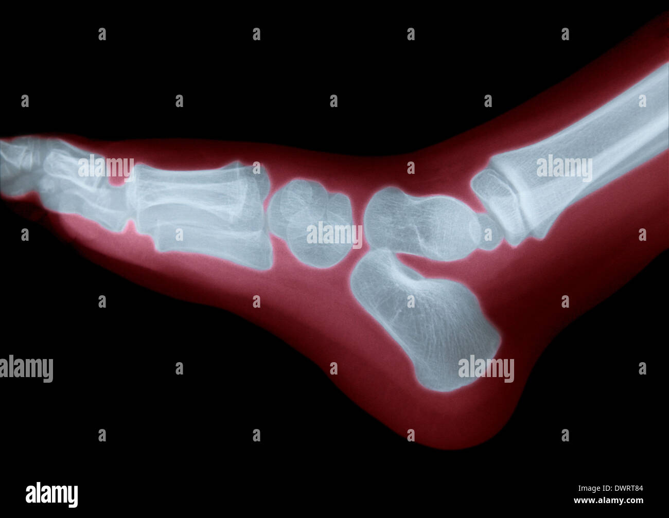 Foot x ray Stock Photo - Alamy