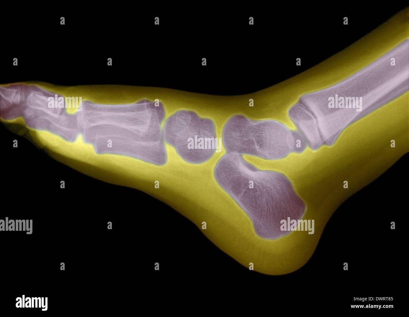 Foot x ray Stock Photo - Alamy