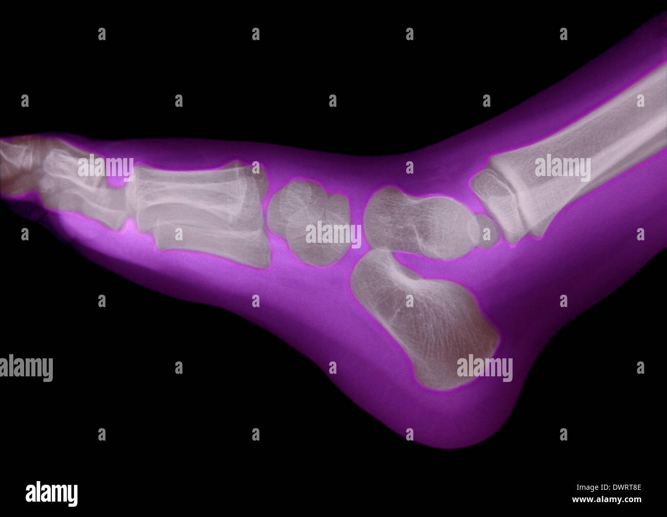 Foot x ray Stock Photo - Alamy