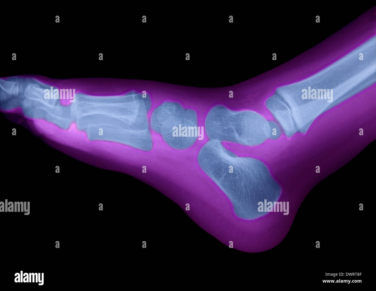 Foot x ray Stock Photo - Alamy