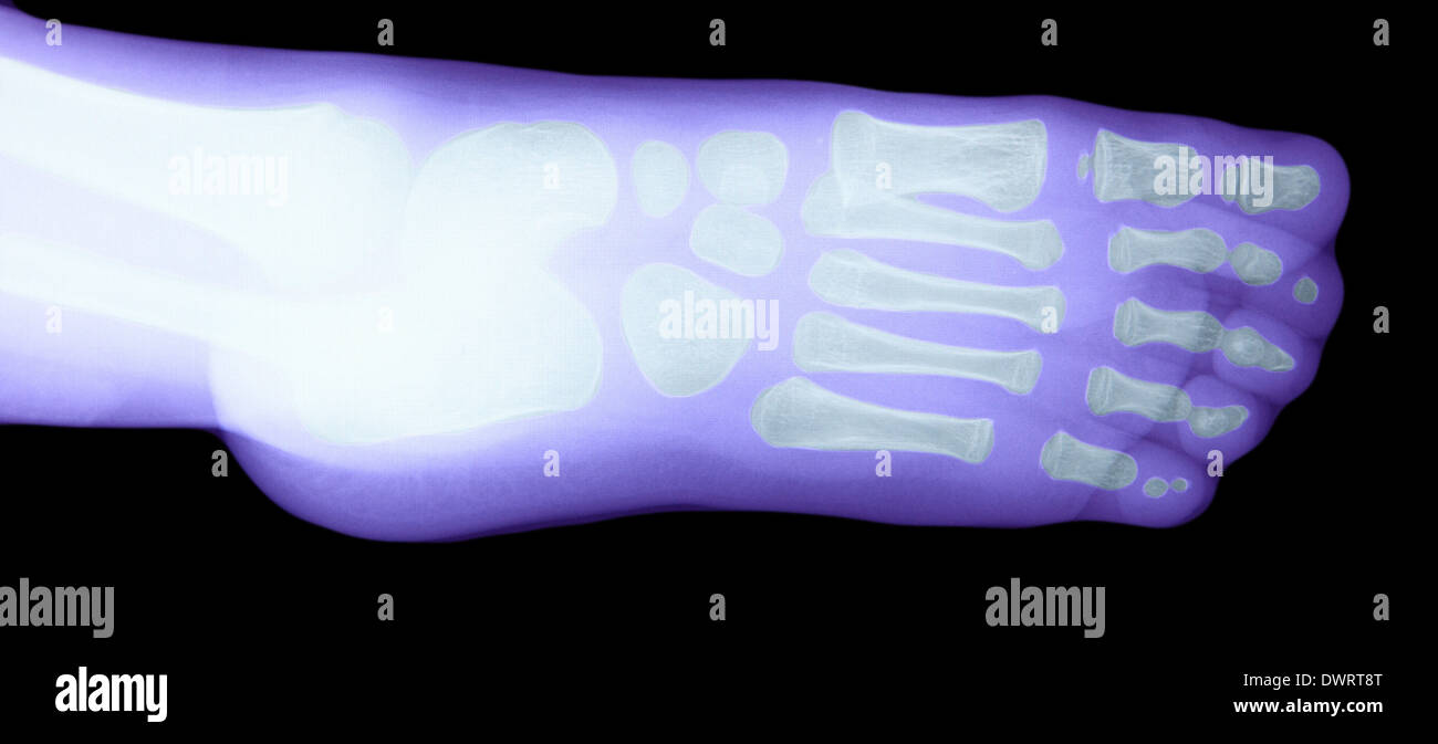 Foot x ray Stock Photo - Alamy