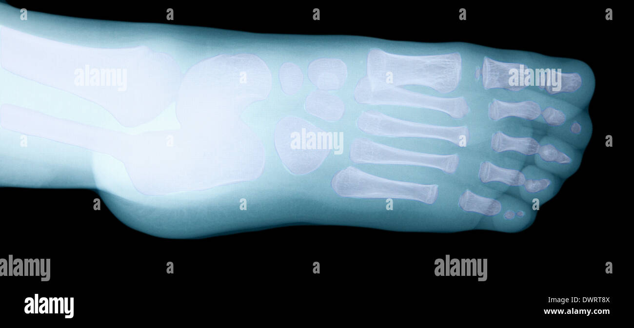 Foot x ray Stock Photo - Alamy