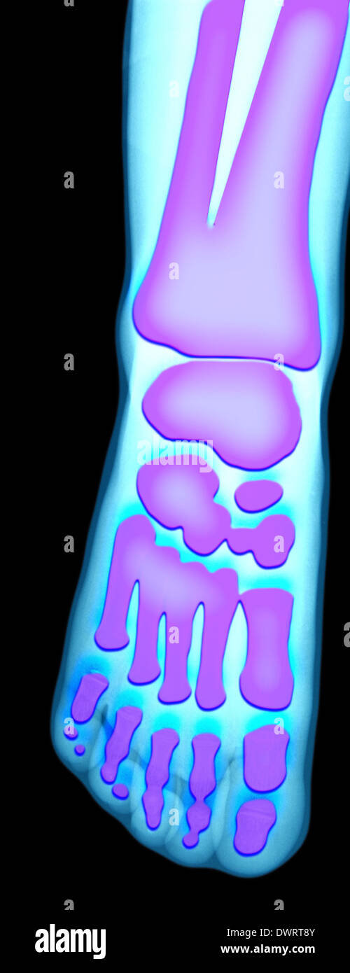 Foot x ray Stock Photo - Alamy