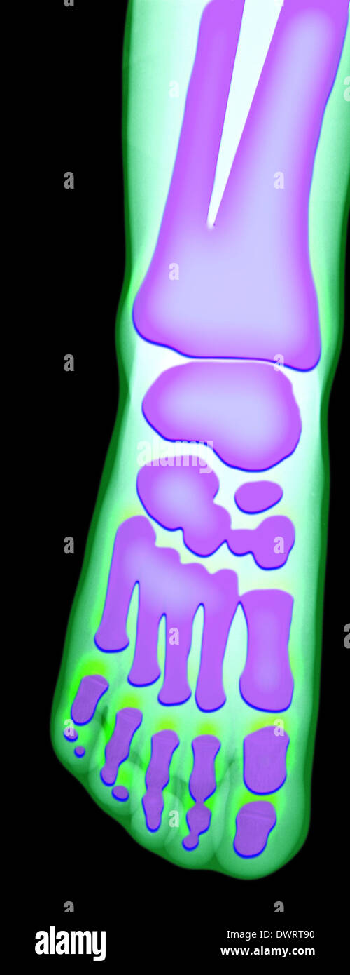 Foot x ray Stock Photo - Alamy
