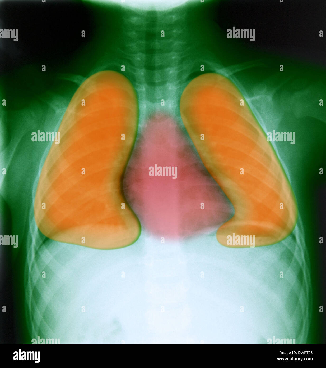 Thorax x ray Stock Photo - Alamy