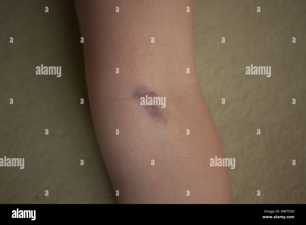 Ecchymosis hi-res stock photography and images - Alamy