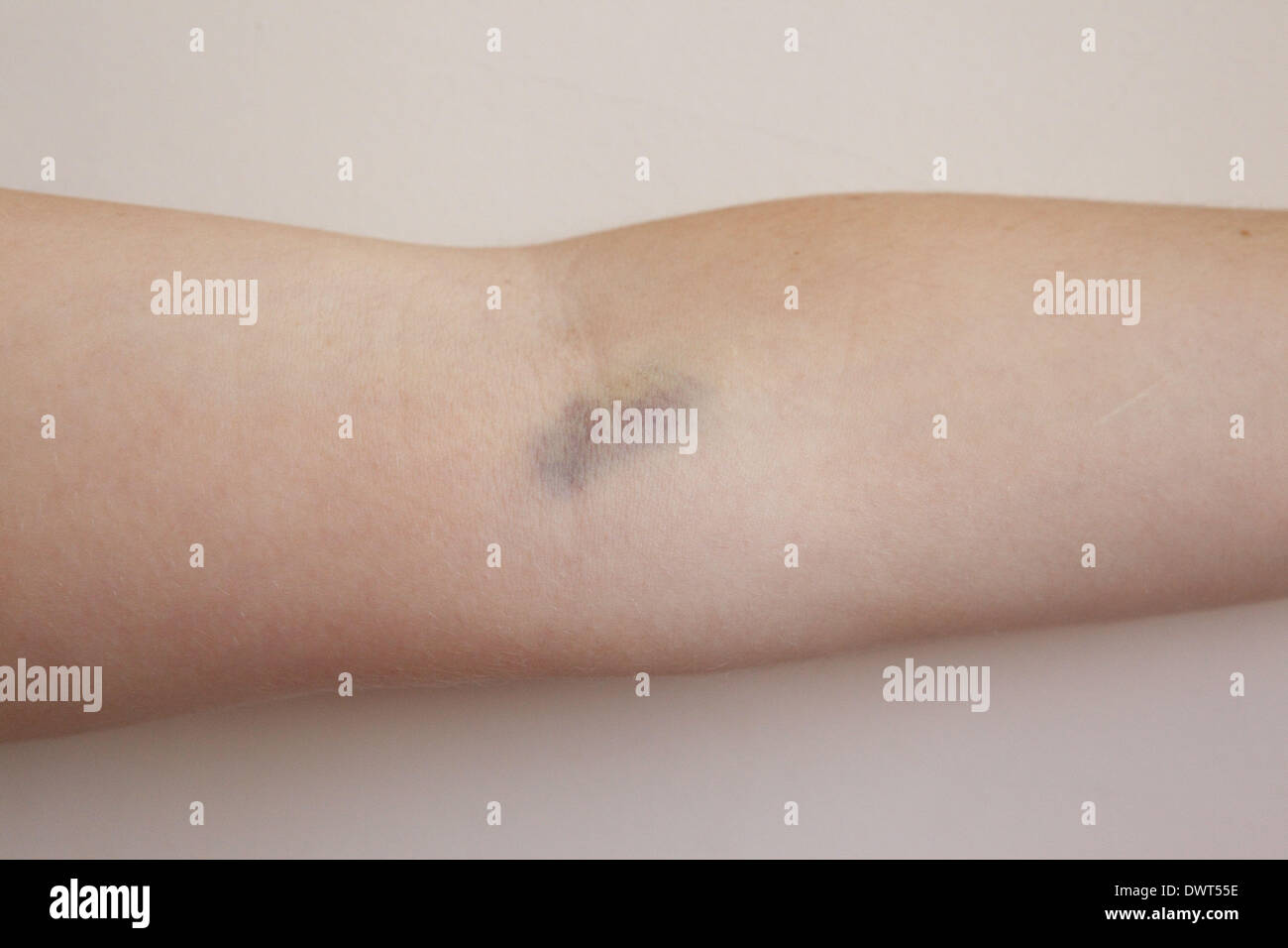 Ecchymosis hi-res stock photography and images - Alamy