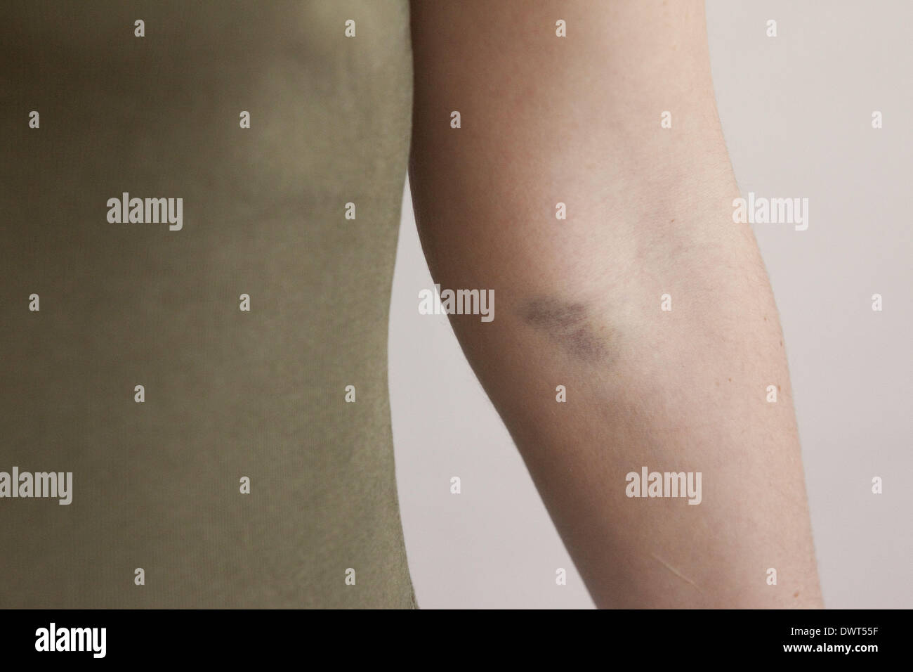 Ecchymosis hi-res stock photography and images - Alamy