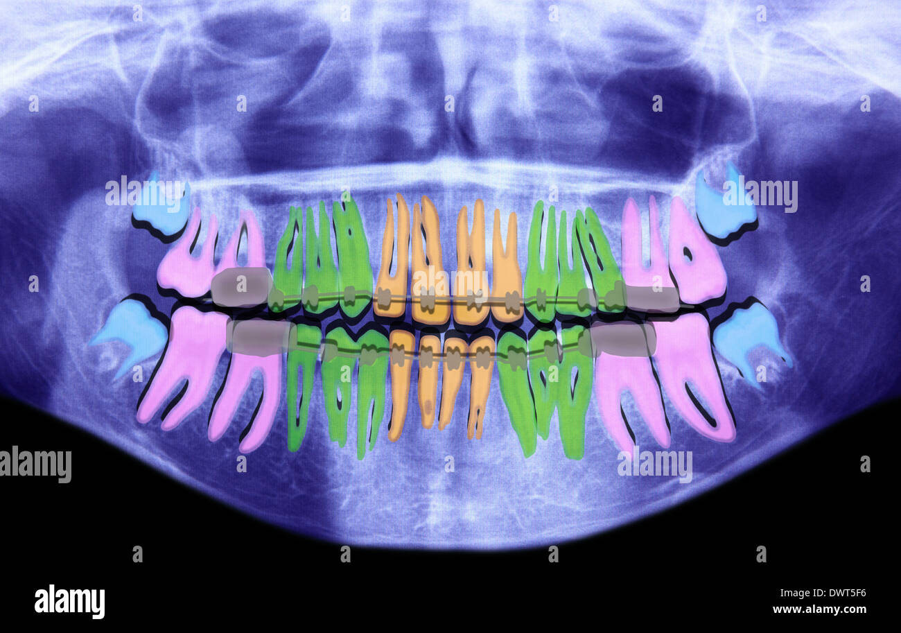 The result of dental radiography hi-res stock photography and images ...