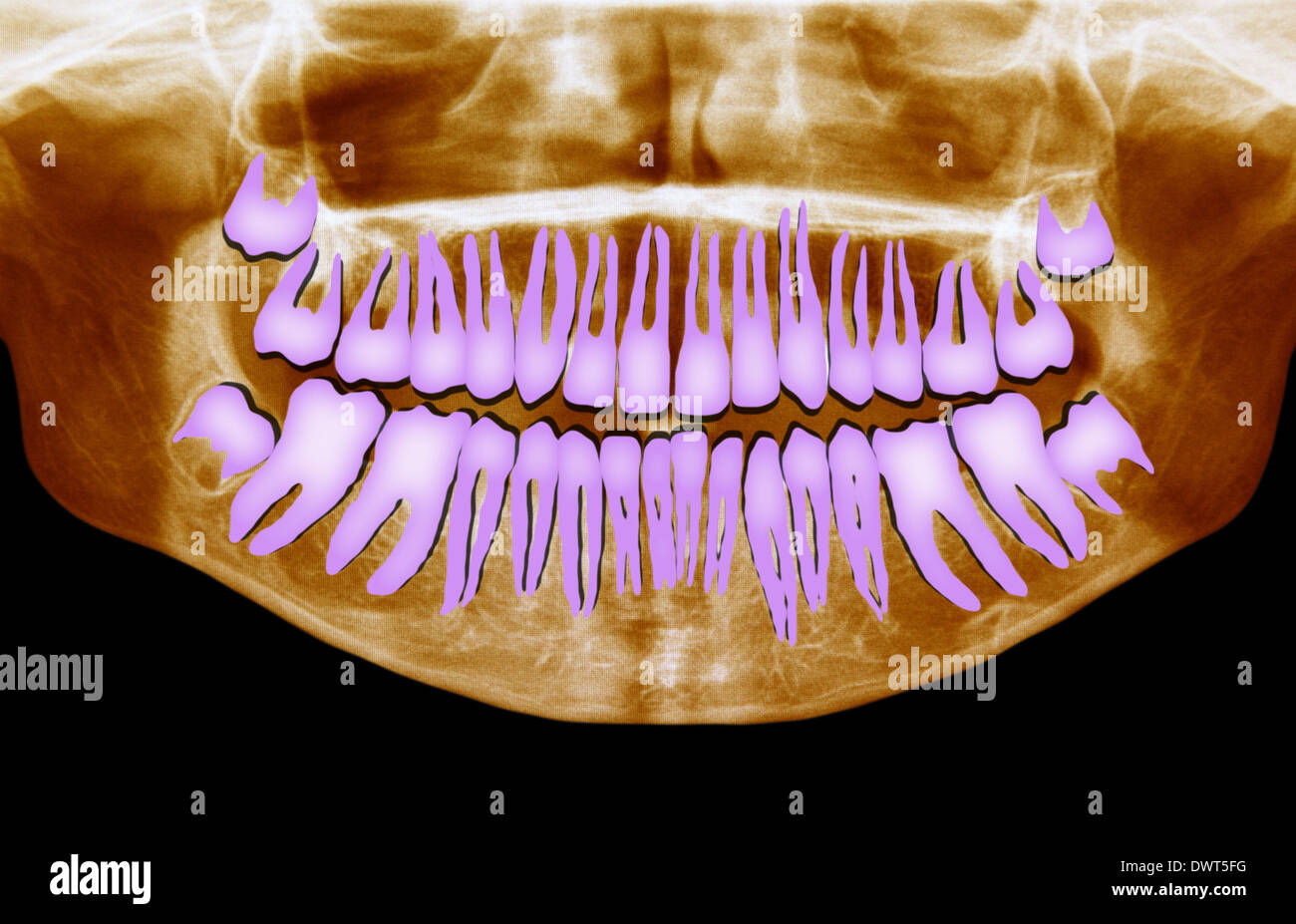 Inferior Maxillary Bone High Resolution Stock Photography and Images ...
