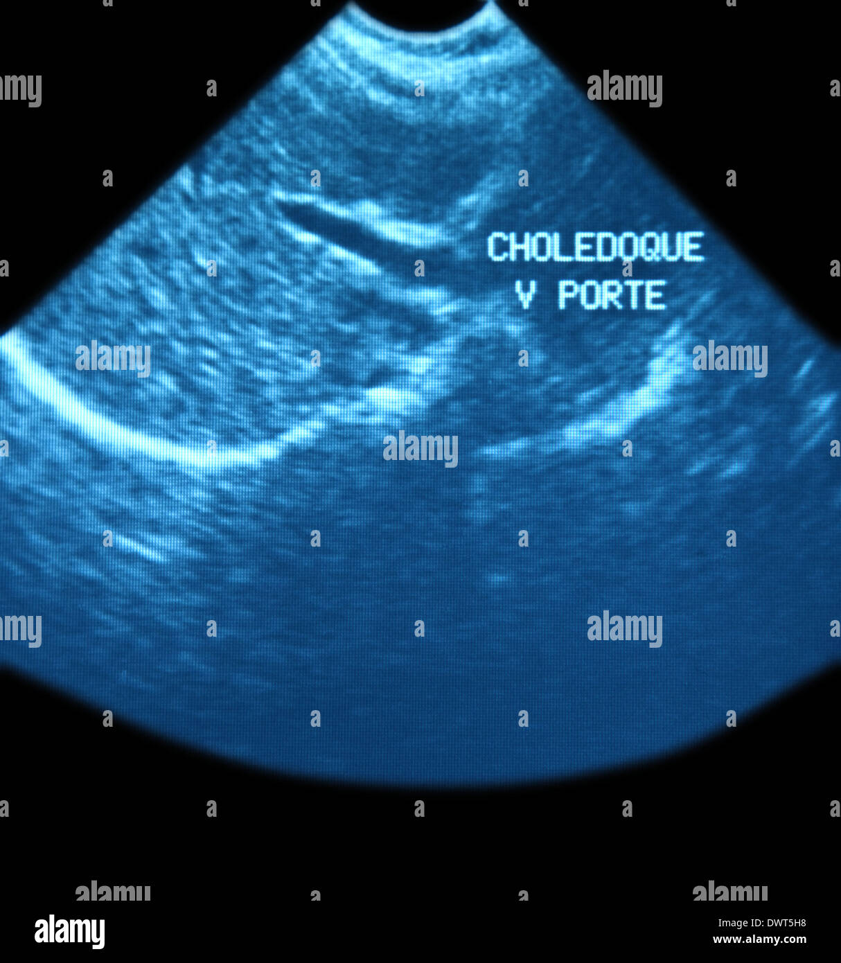 Common Hepatic Duct Ultrasound Diagnostic Approach To Biliary