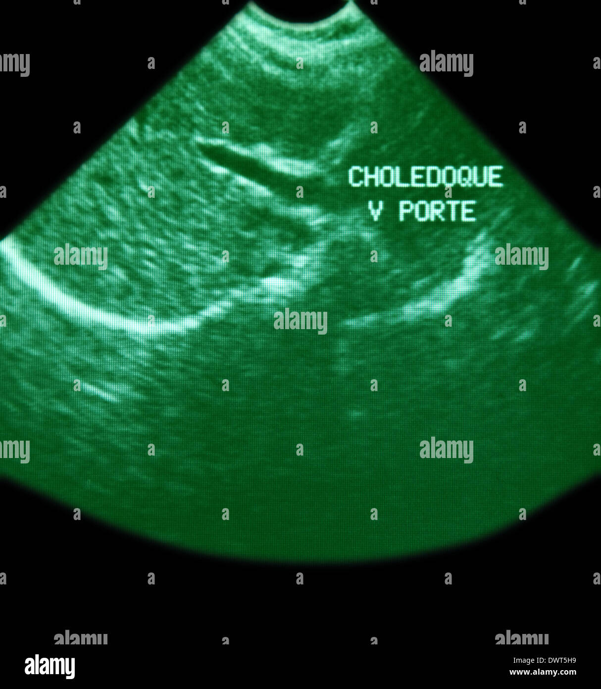 Common Bile Duct Ultrasound
