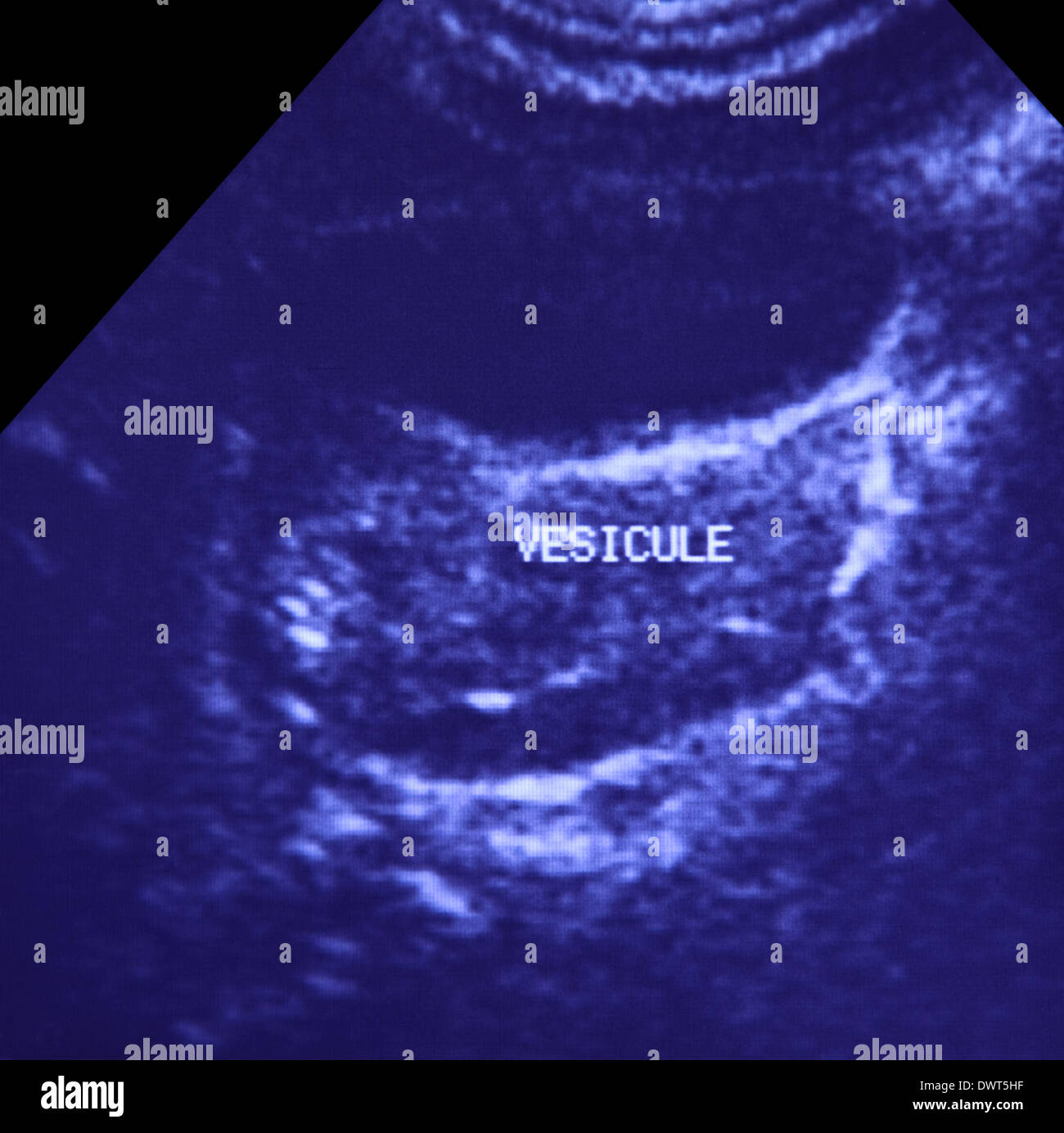 Gallbladder ultrasound scan Stock Photo - Alamy