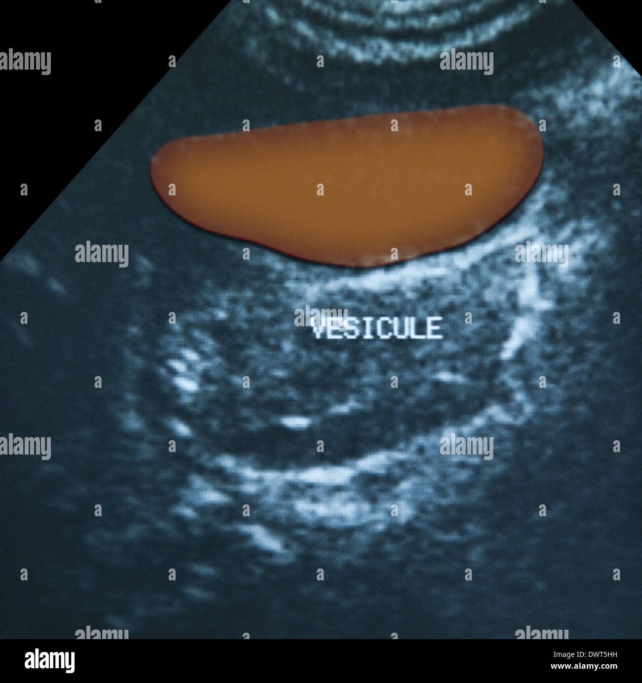 Gallbladder ultrasound scan Stock Photo - Alamy