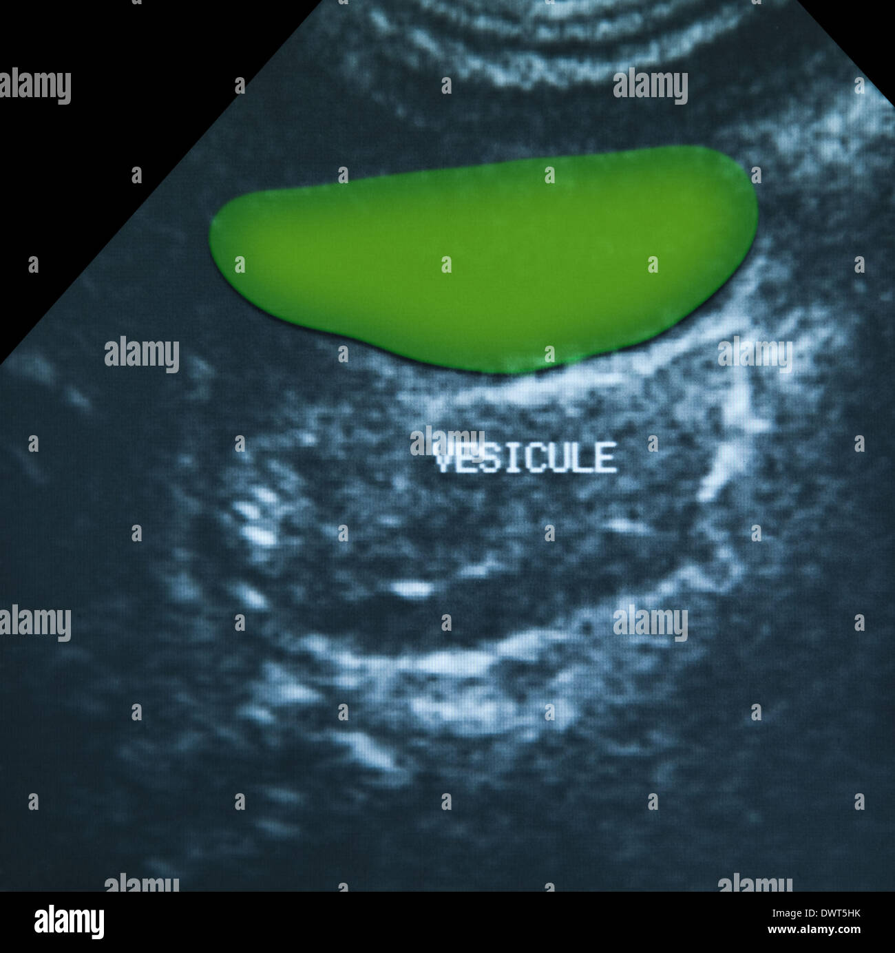 Gallbladder ultrasound hi-res stock photography and images - Alamy