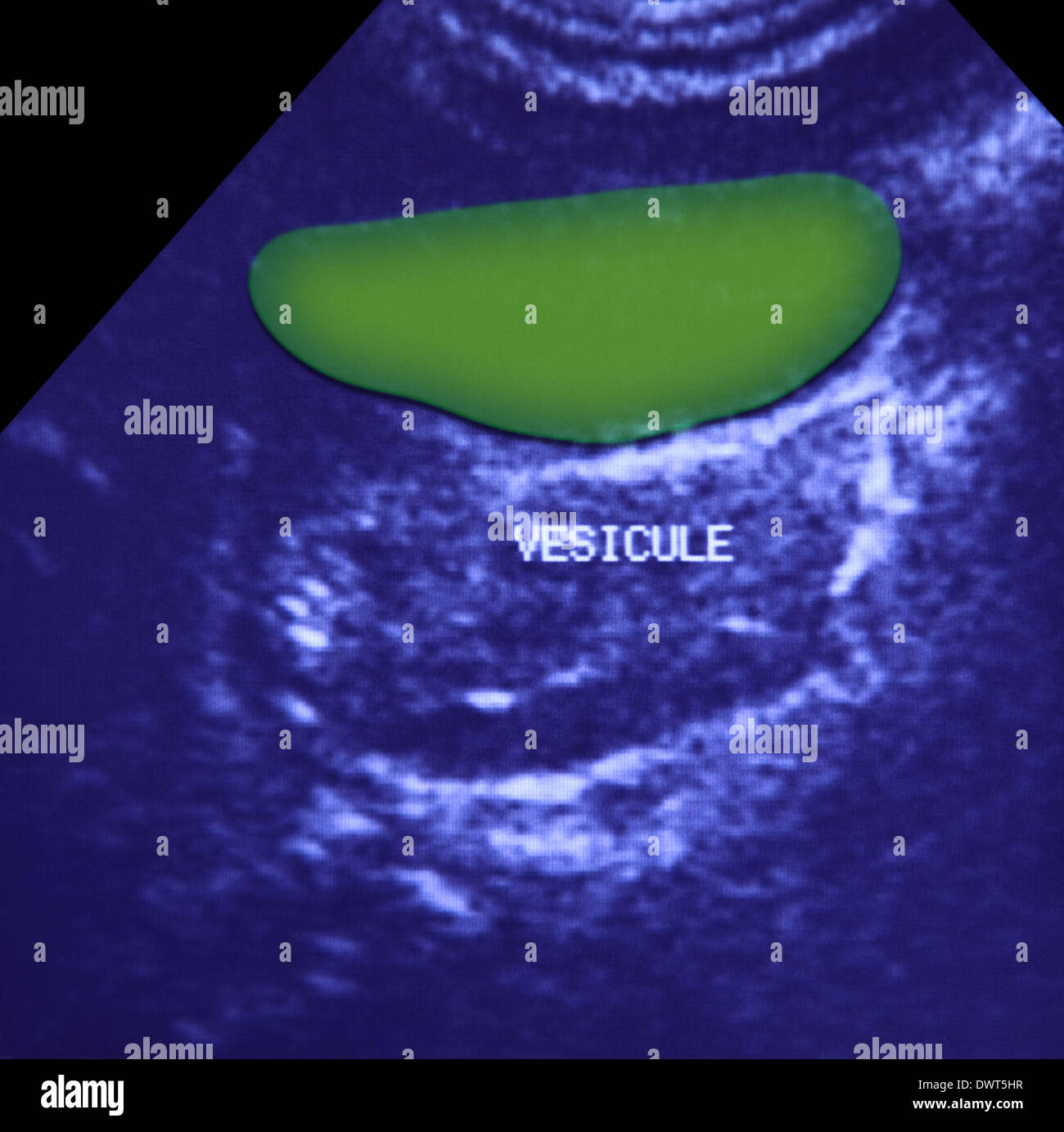 Gallbladder ultrasound scan hi-res stock photography and images - Alamy