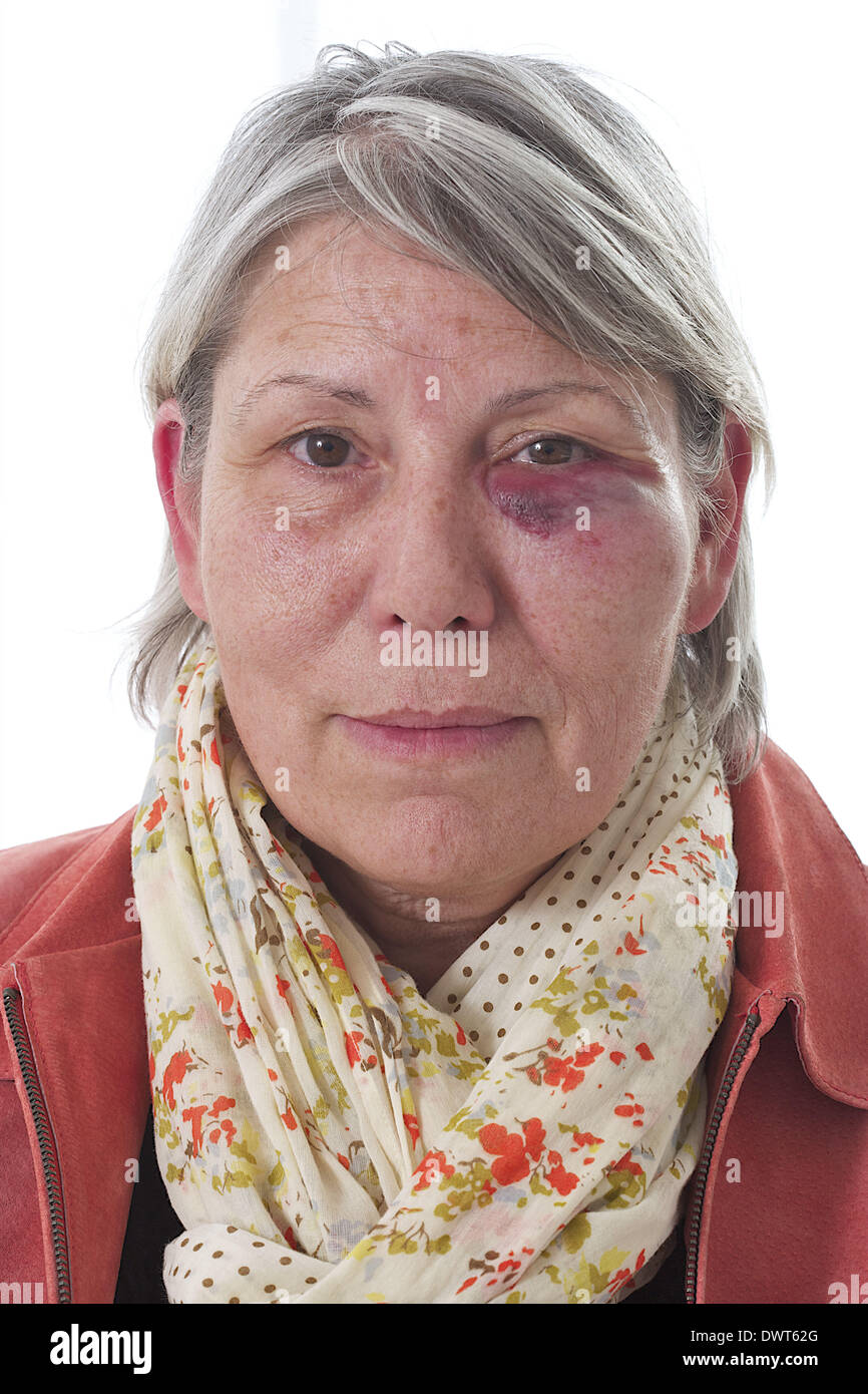 Traumatic hematoma hi-res stock photography and images - Alamy