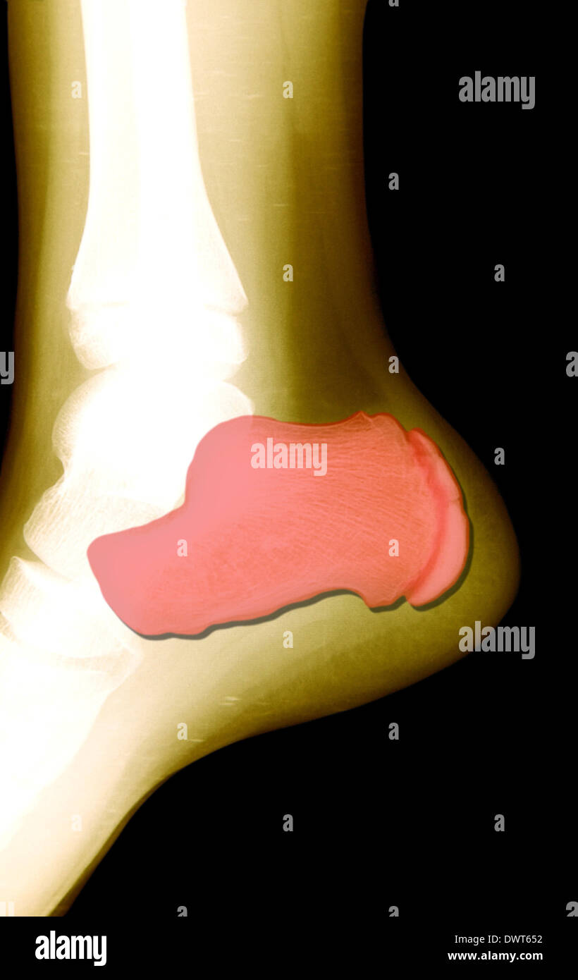 Apophysitis calcaneus hi-res stock photography and images - Alamy