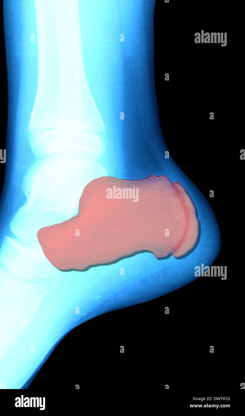 Apophysitis calcaneus hi-res stock photography and images - Alamy