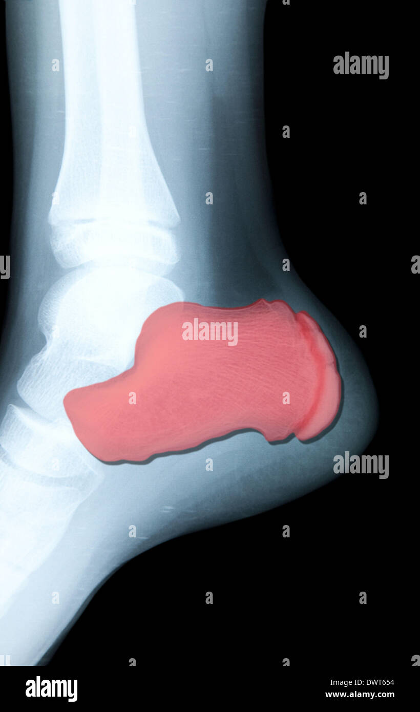 Sever’s disease hi-res stock photography and images - Alamy