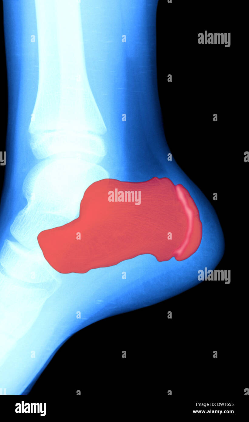 Severs disease hi-res stock photography and images - Alamy