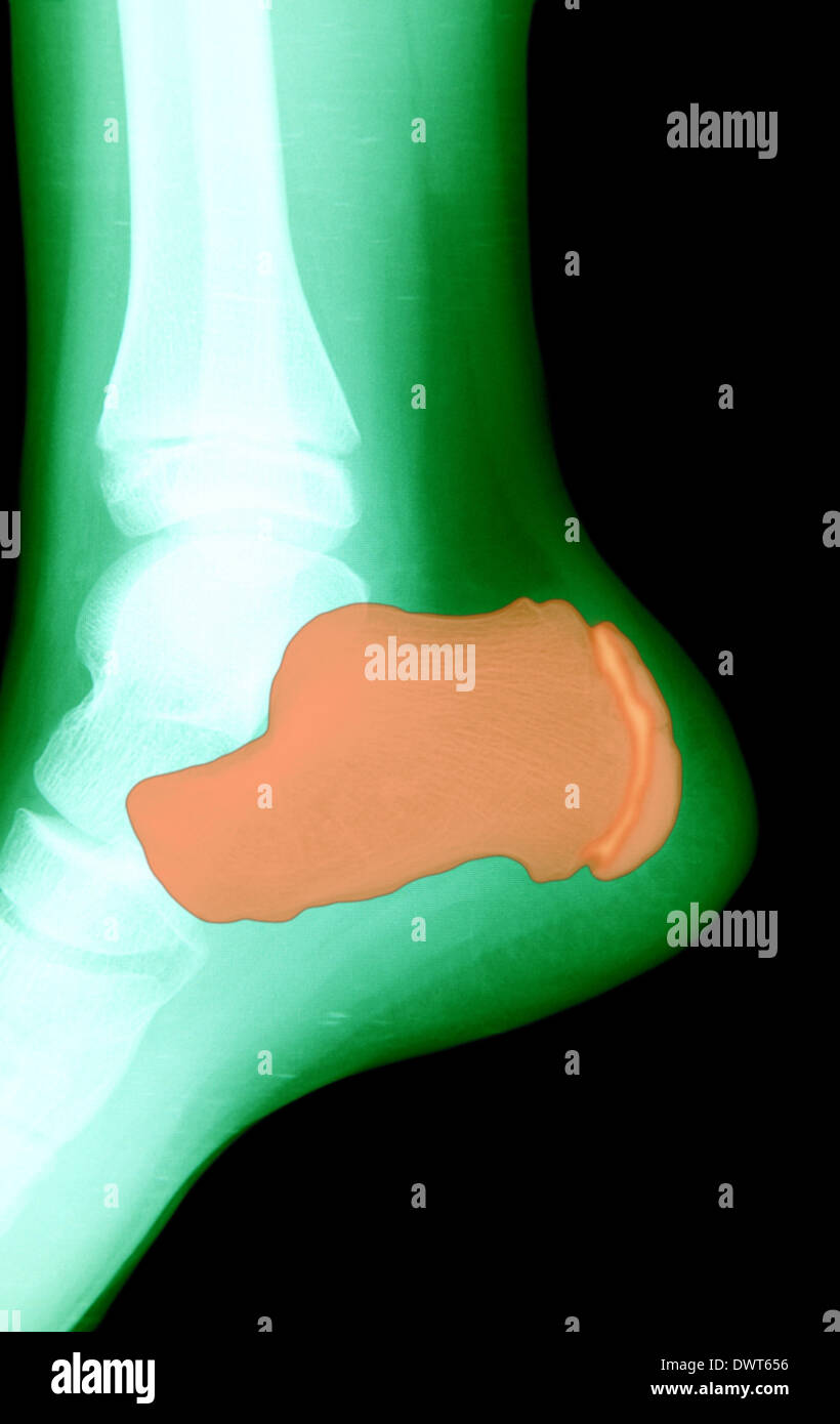 Sever’s disease hi-res stock photography and images - Alamy