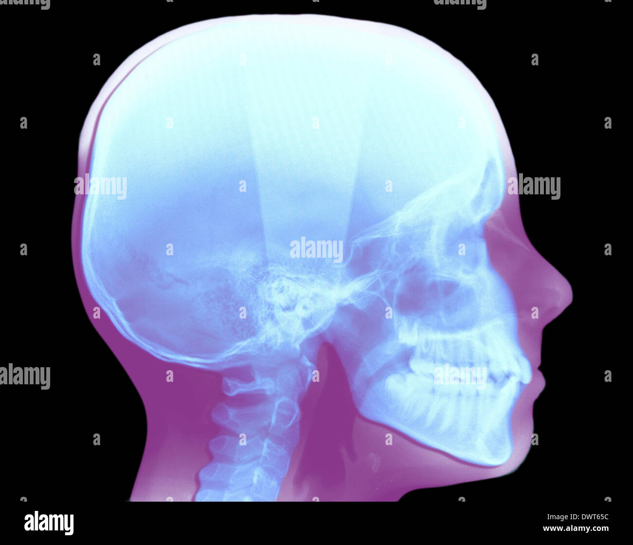 Head x ray Stock Photo - Alamy