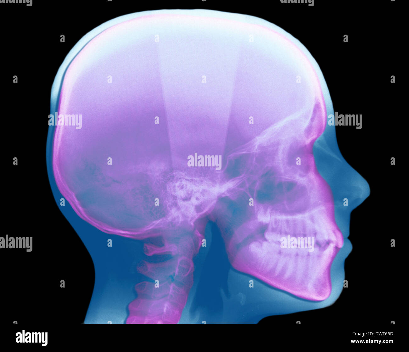 Head x ray Stock Photo - Alamy