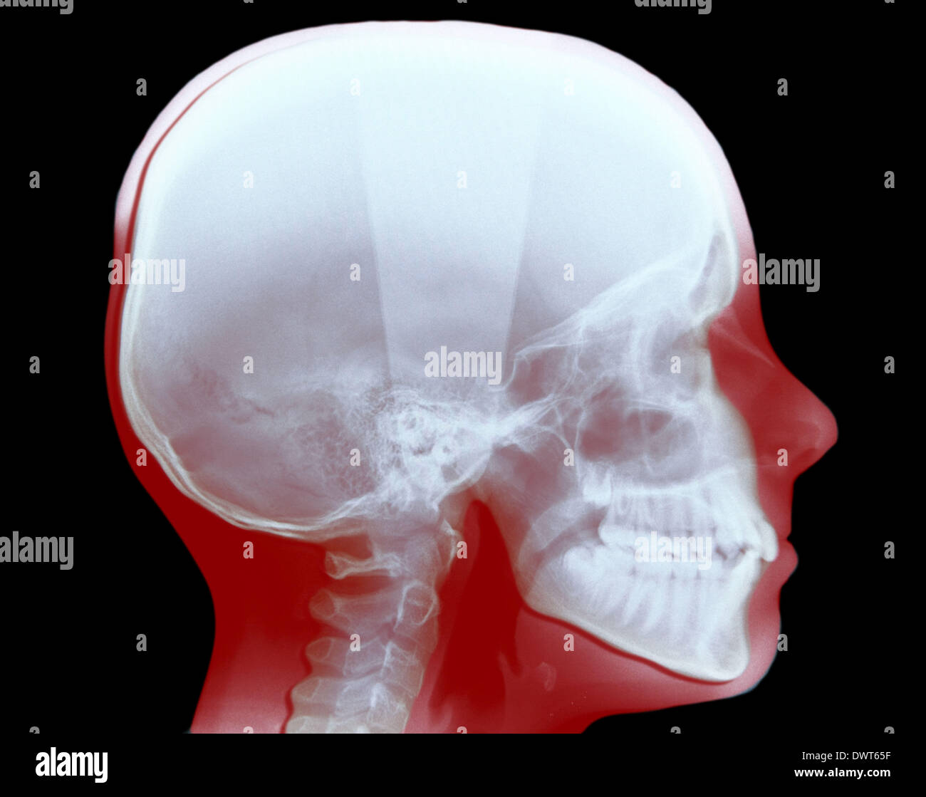 Head x ray Stock Photo - Alamy
