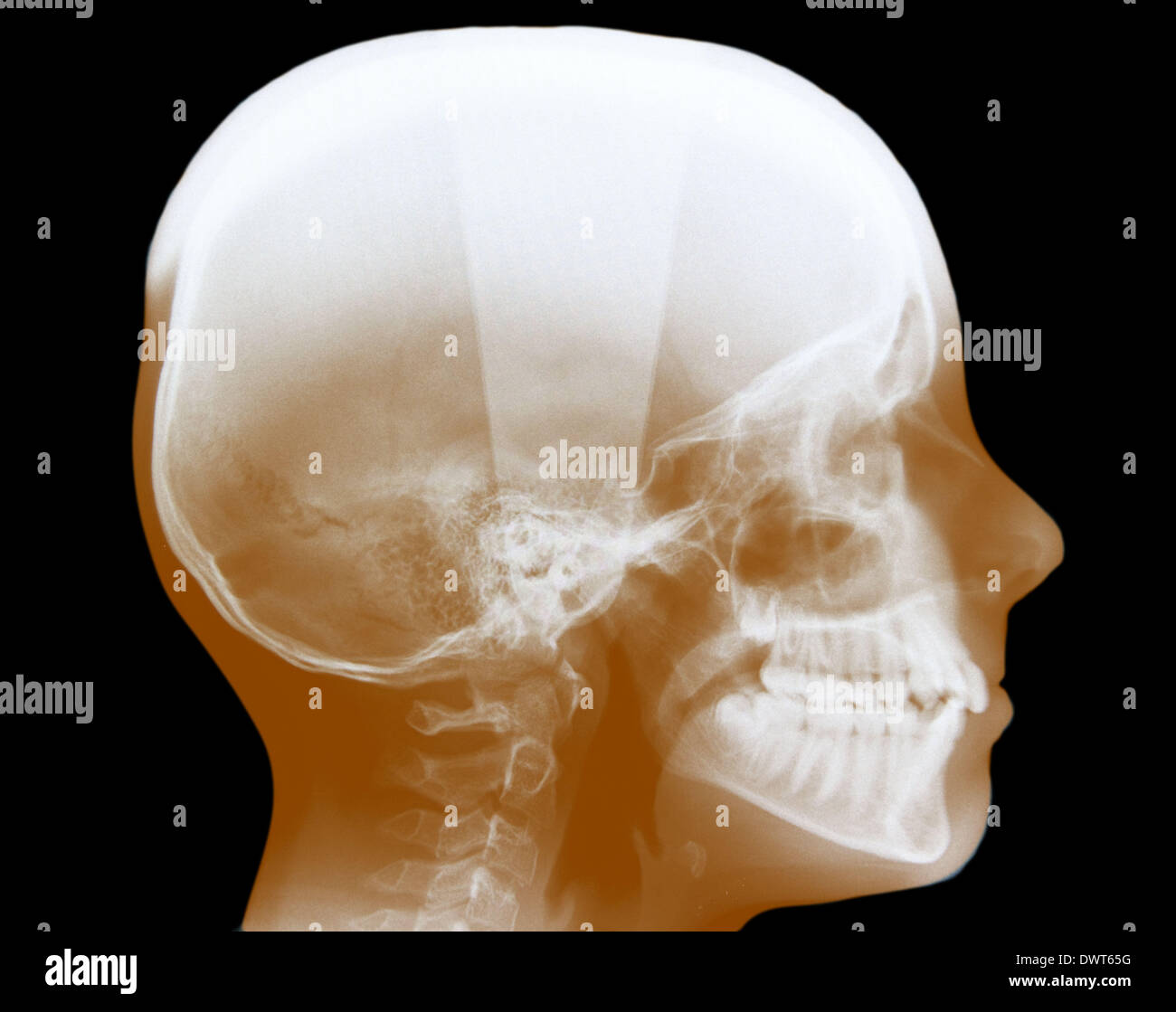 Head x ray Stock Photo - Alamy