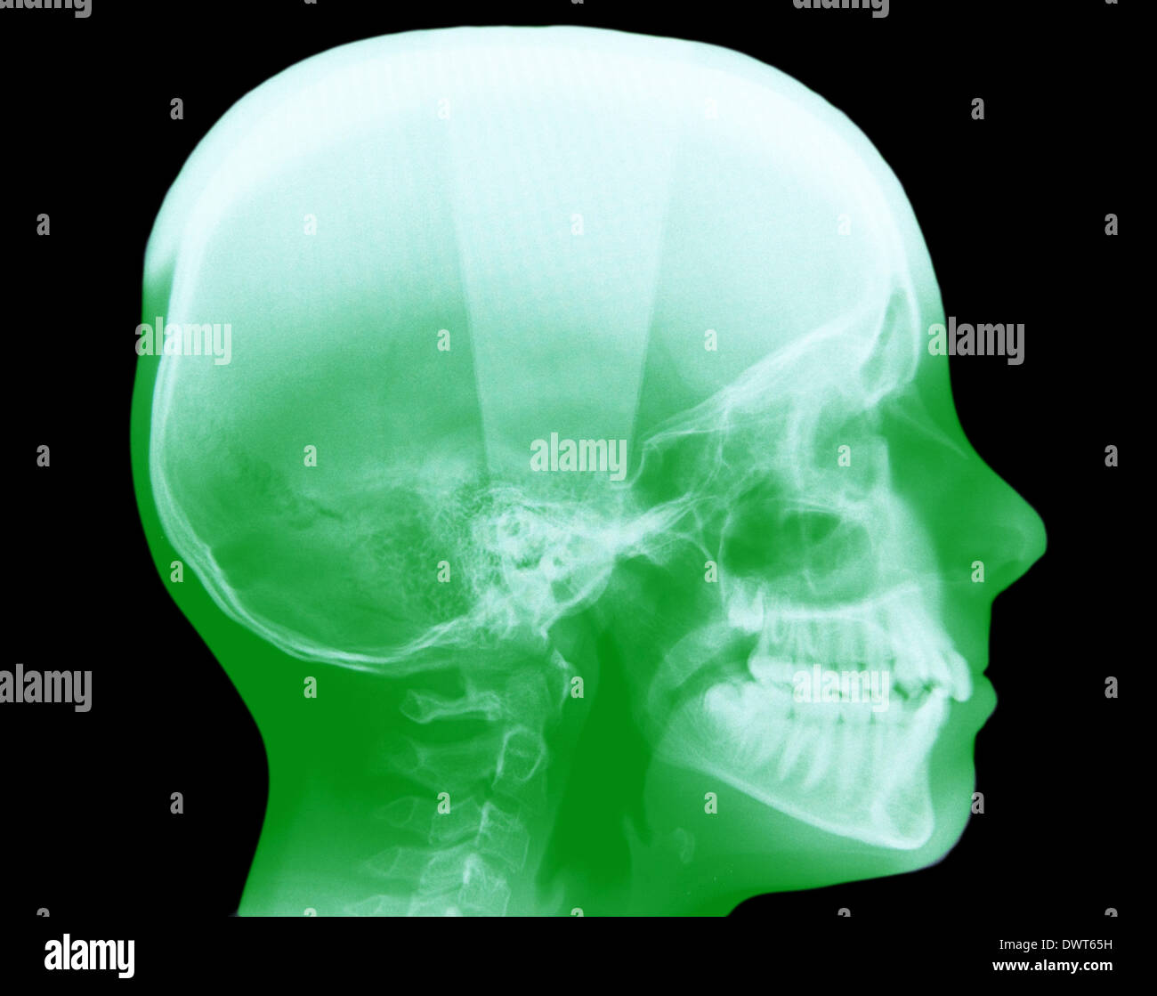 Head x ray Stock Photo - Alamy