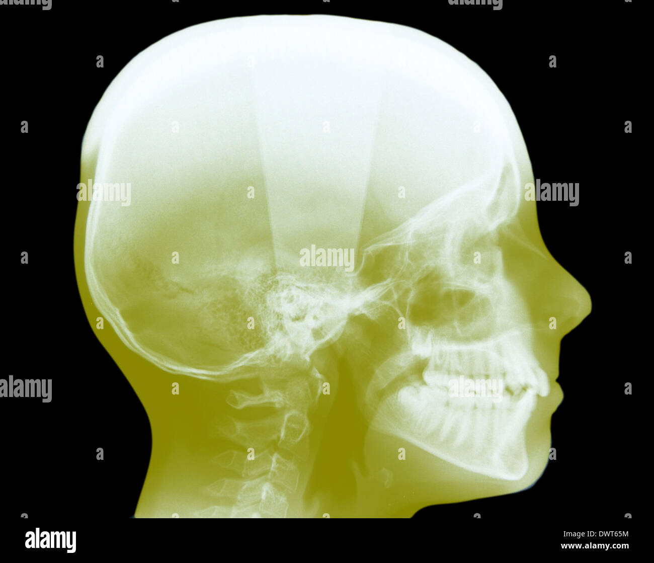 Head x ray Stock Photo - Alamy