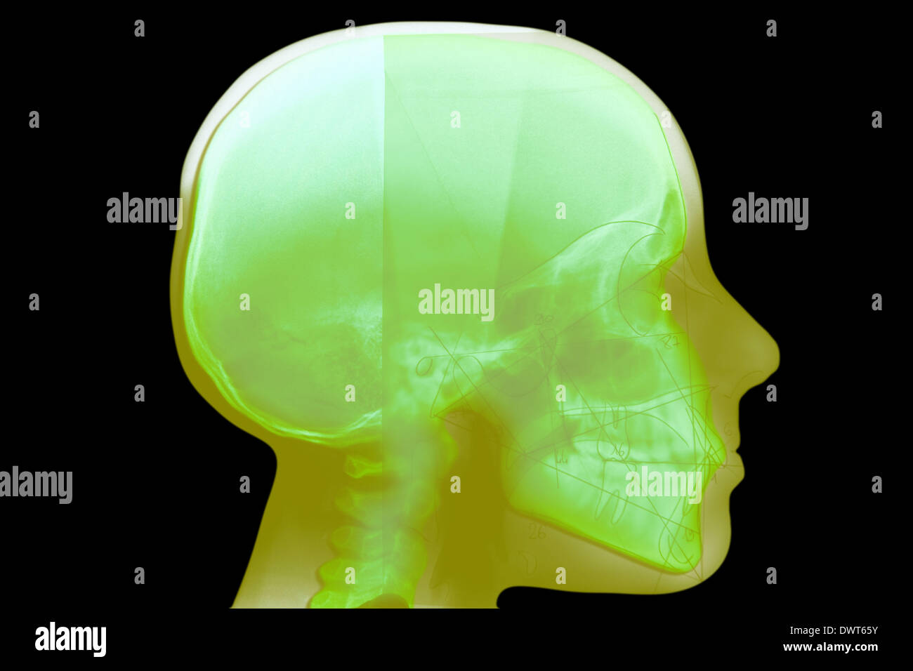 Telecranium hi-res stock photography and images - Alamy