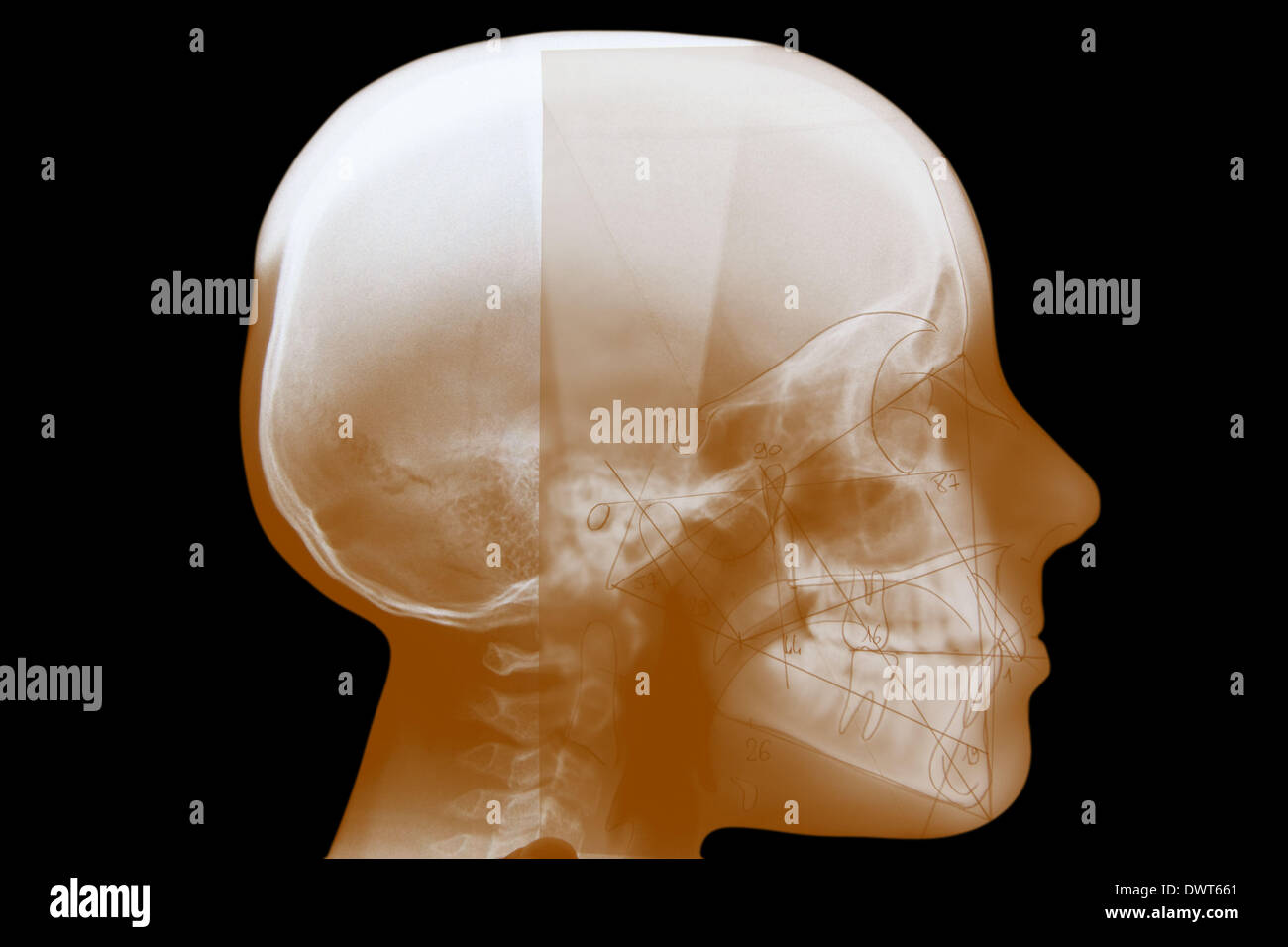 Telecranium hi-res stock photography and images - Alamy