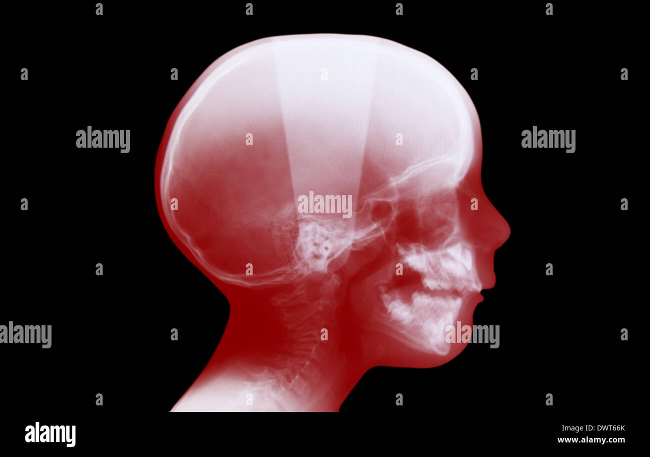 Cephalography hi-res stock photography and images - Alamy