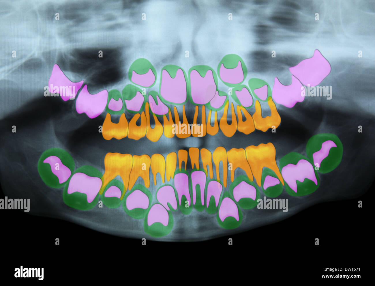 Human dentition permanent hi-res stock photography and images - Alamy