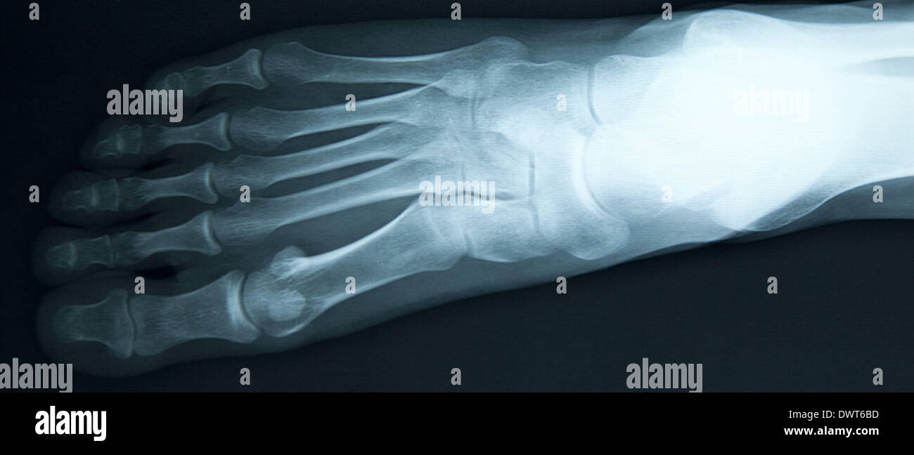 Foot x ray Stock Photo - Alamy