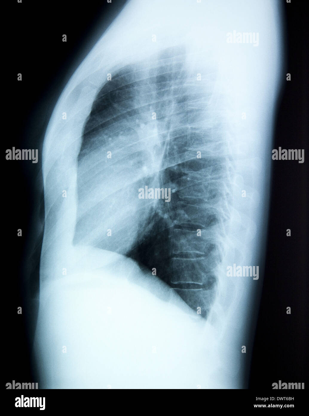 Thorax x ray Stock Photo - Alamy