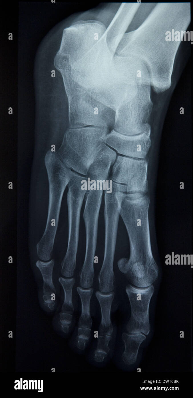 Foot x ray Stock Photo - Alamy