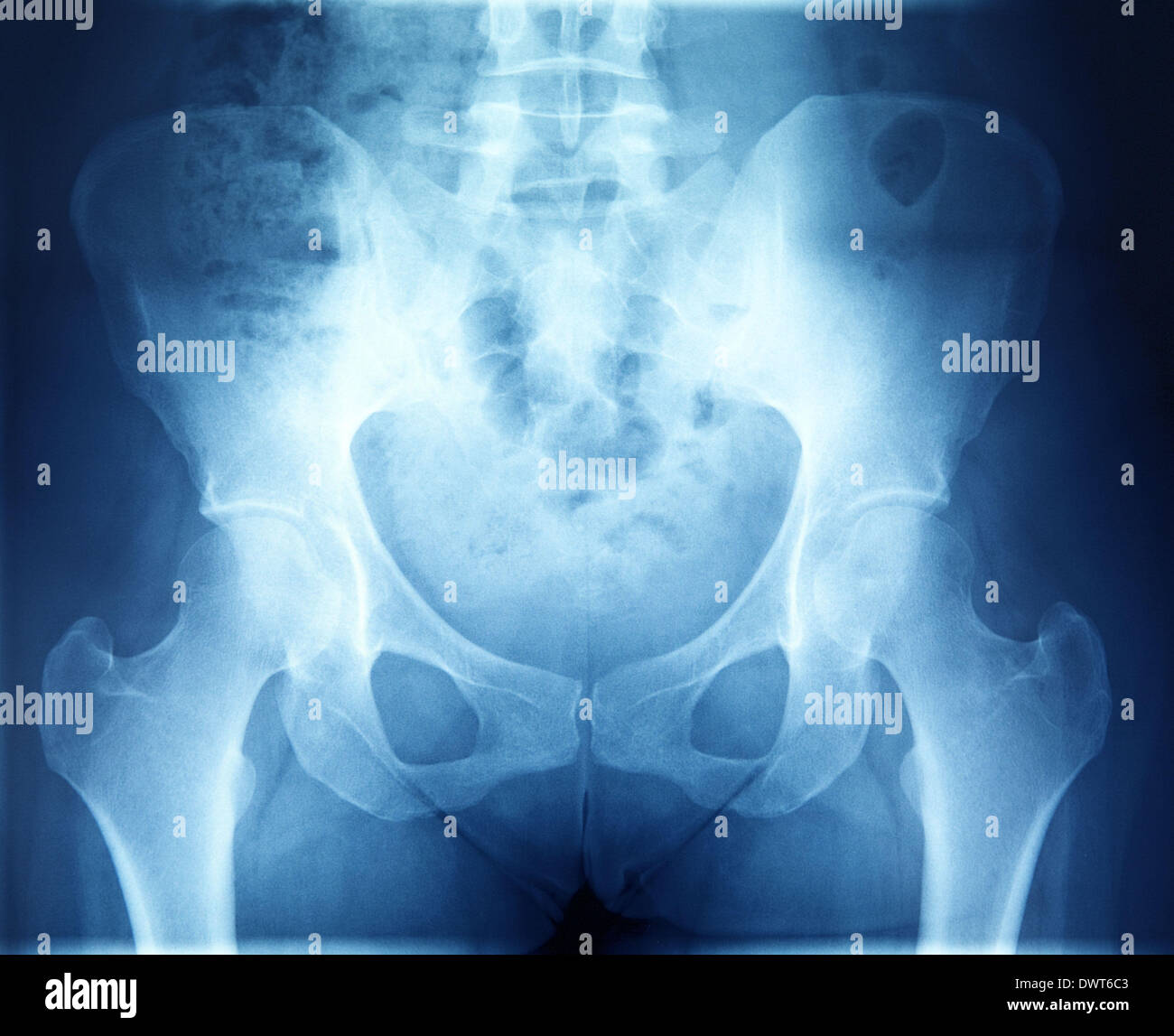Pelvis x ray Stock Photo - Alamy