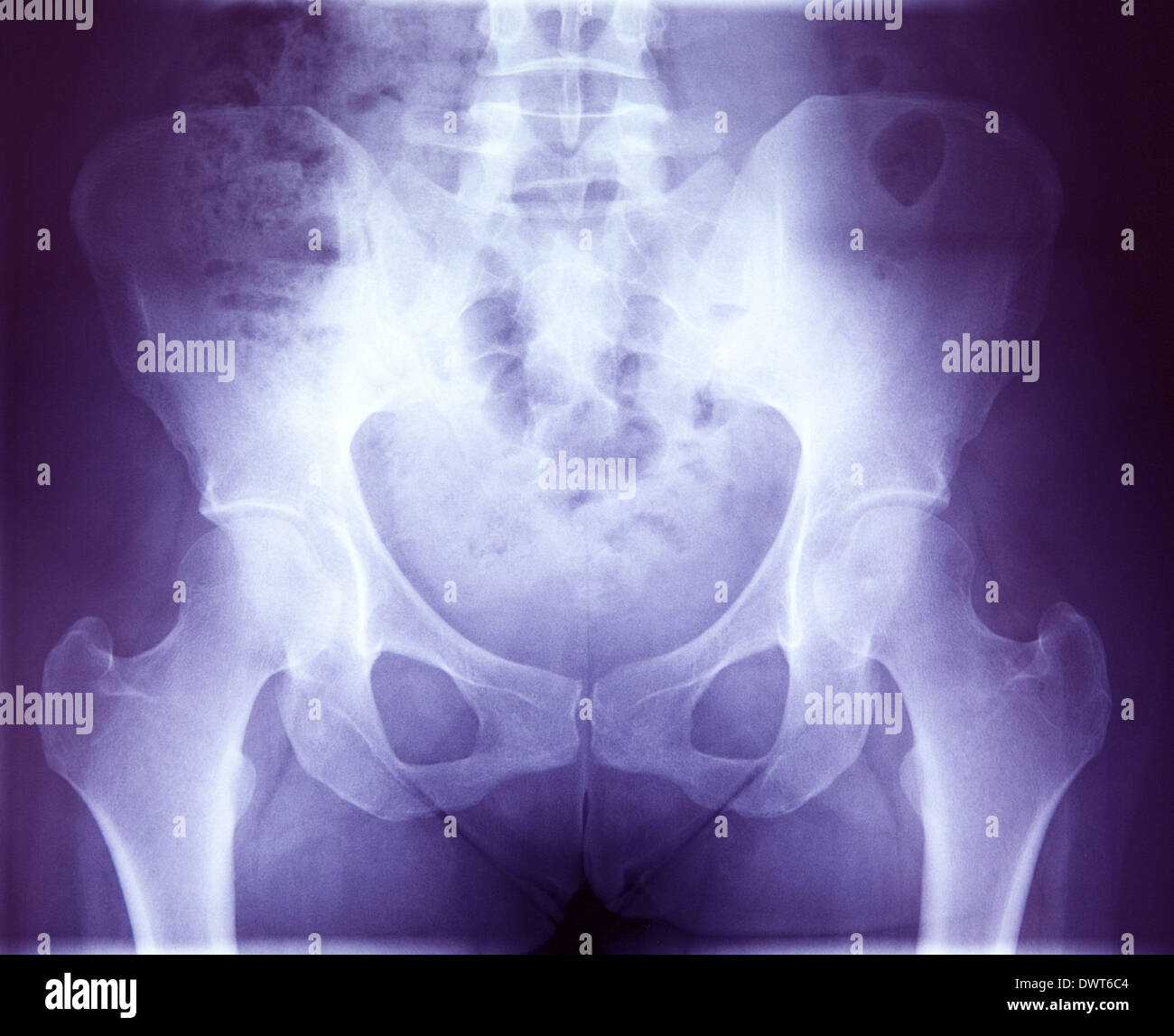 Pelvis x ray Stock Photo - Alamy