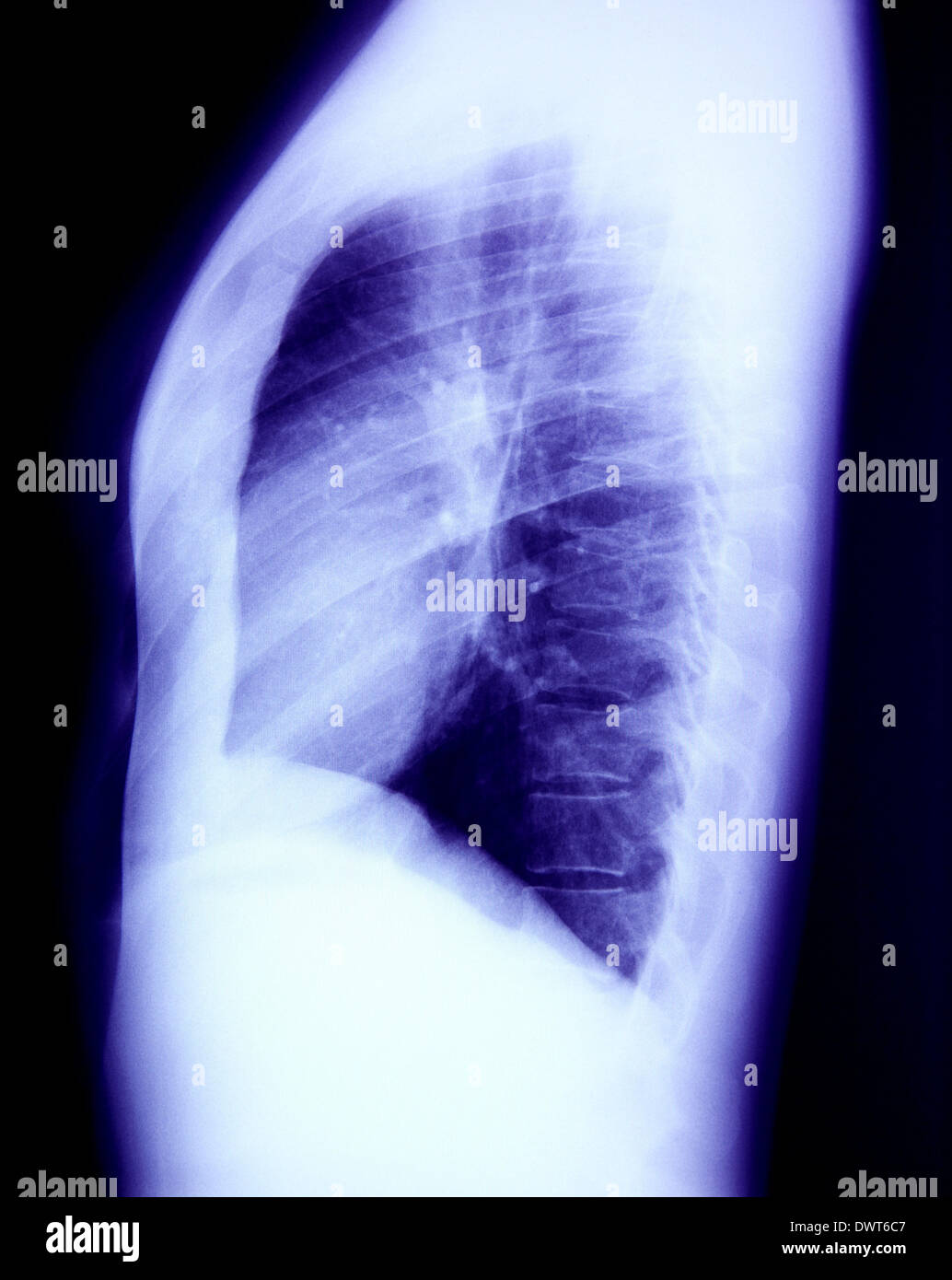 Thorax x ray Stock Photo - Alamy