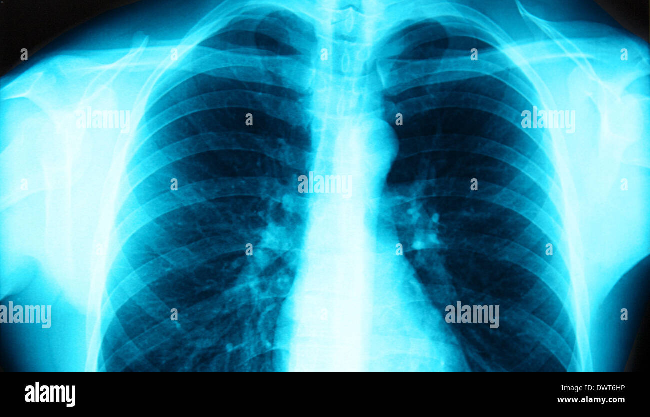 Thorax x ray Stock Photo - Alamy