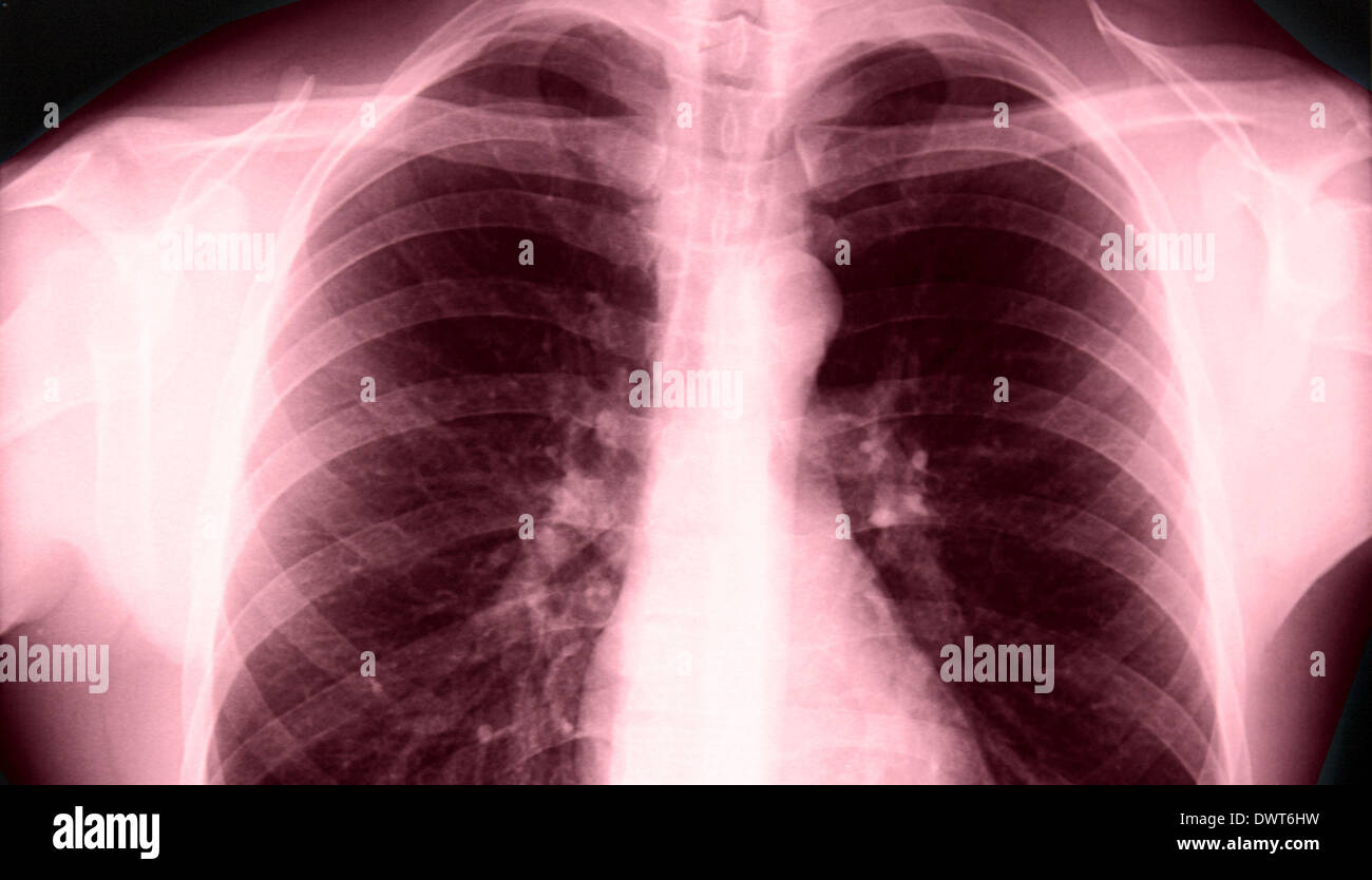 Thorax x ray Stock Photo - Alamy